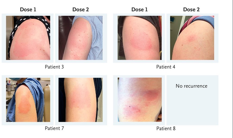 Some Get Large Rash On Arm After Moderna Vaccine – Lacto Bacto